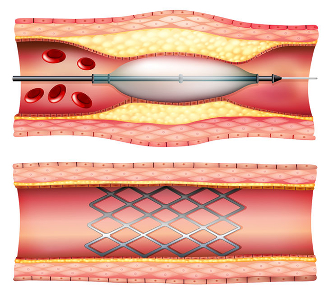 Diagnostic Cardiac Catheterization | South Strand Cardiology